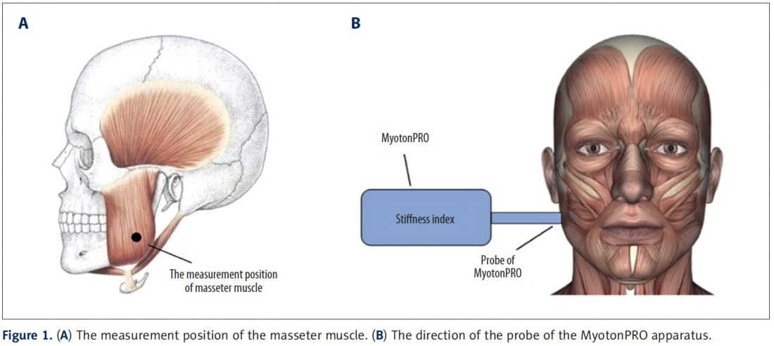 Quantification of the Masseter Muscle Hardness of Stroke Patients Using ...