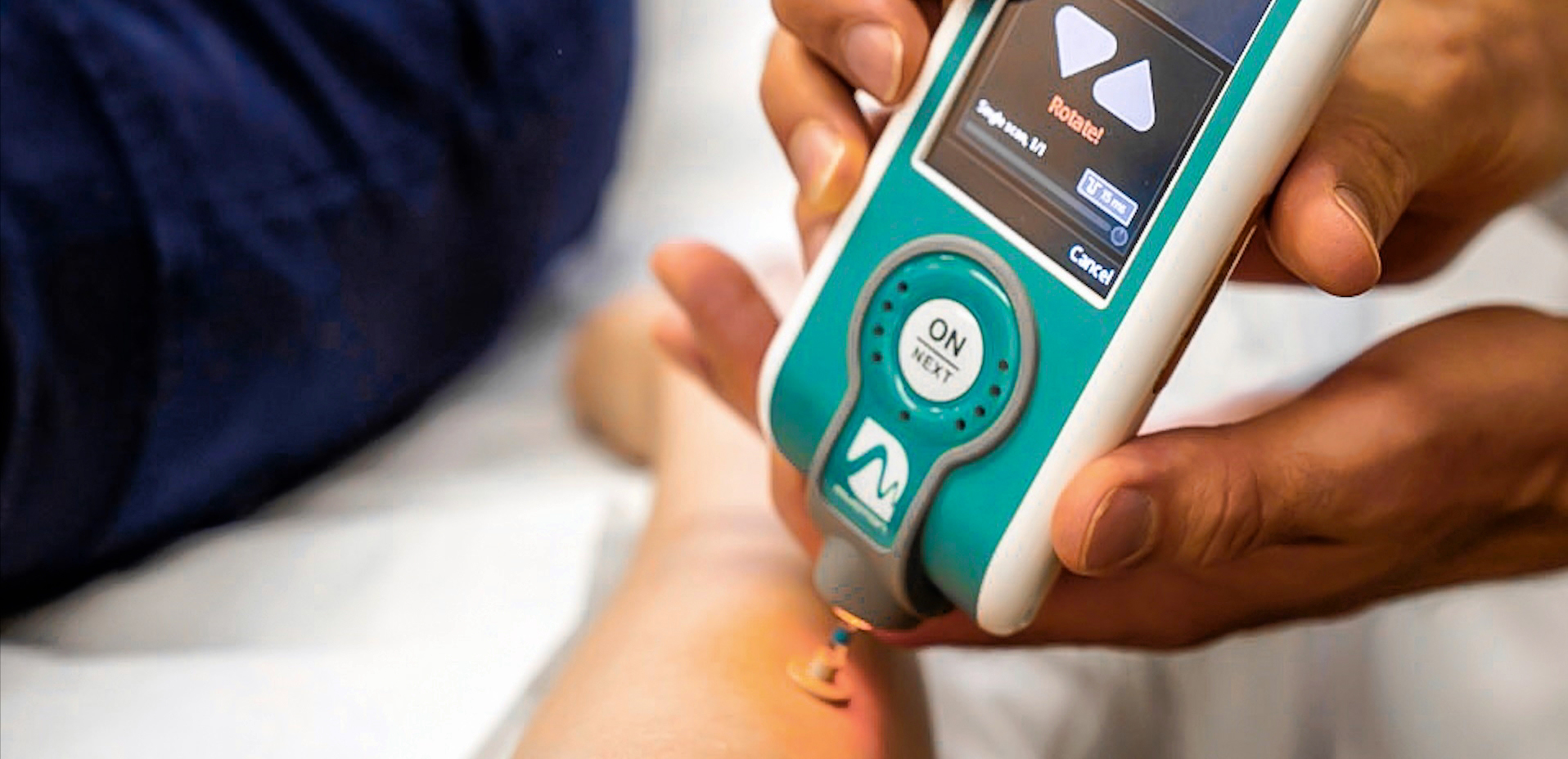 Measuring Skin Stiffness to Monitor Sclerotic cGVHD - Myoton