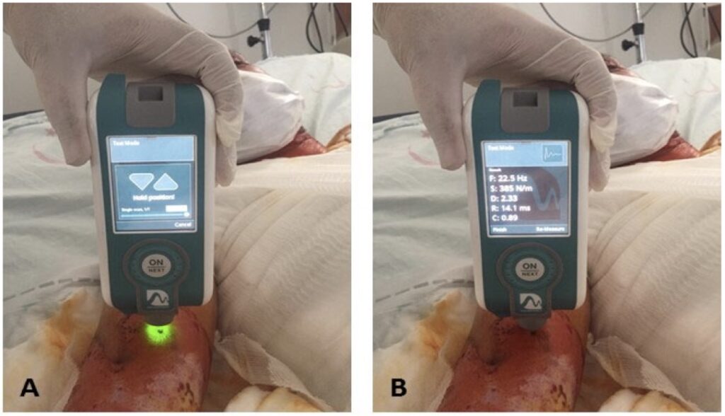 An Investigation of Muscle Mechanical Properties in Acute Burns and ...